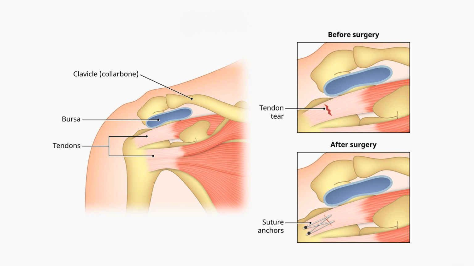 When Can I Sleep on My Side After Shoulder Surgery? - Easy Rest
