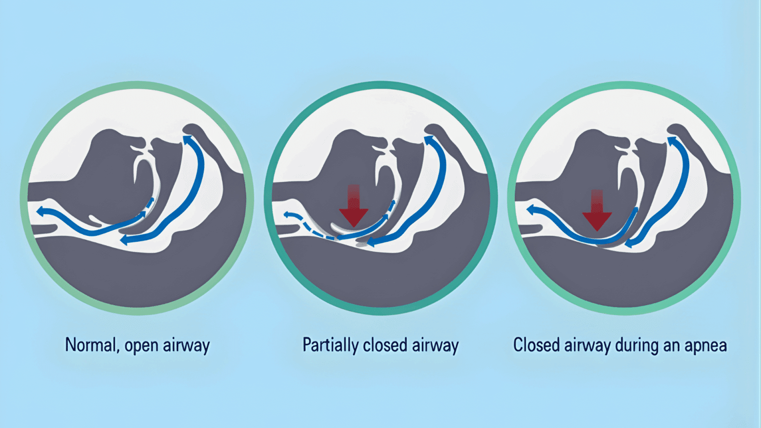 Can Sleep Apnea Kill You? (Facts You Should Know) - Easy Rest